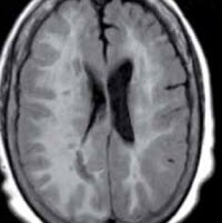 Neuroimaging of Epilepsy: A Review of MRI Findings in Uncommon ...