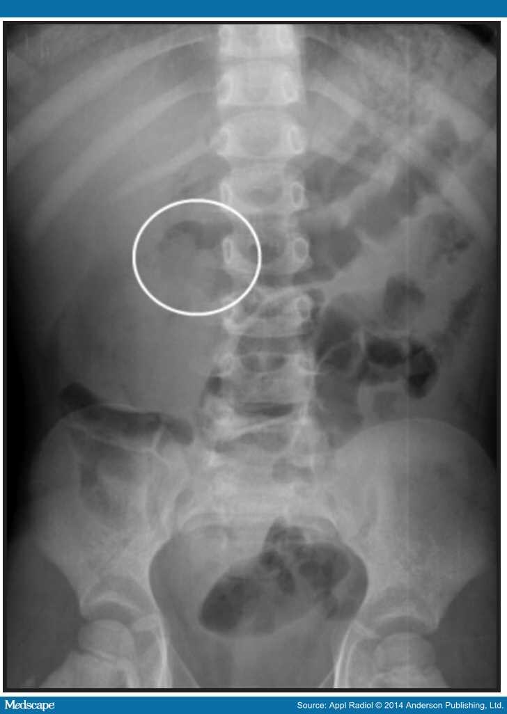 Radiological Case: Intussusception