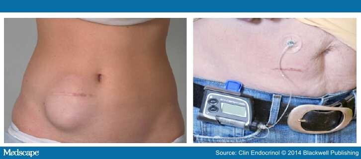 Intraperitoneal Insulin Infusion: Option for Type 1 Diabetes