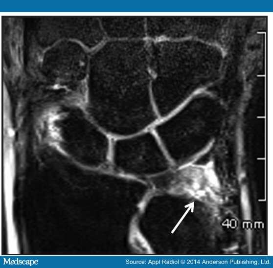 MRI of the Wrist