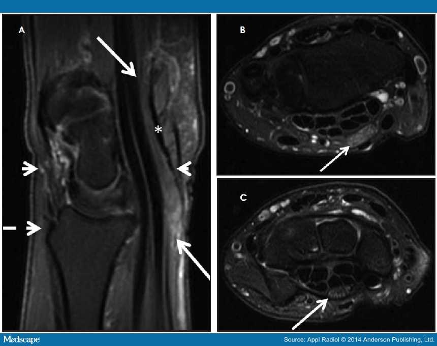MRI of the Wrist