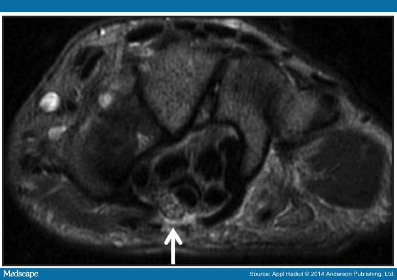 MRI of the Wrist