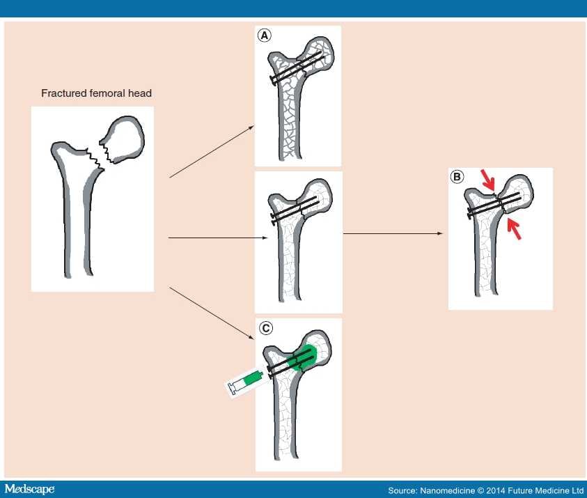 Nanomaterials: The Next Step in Injectable Bone Cements
