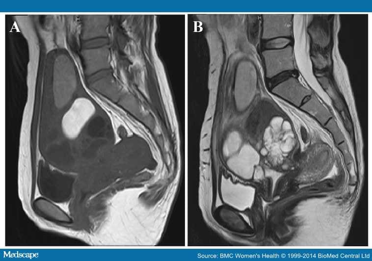 Huge Pyogenic Cervical Cyst With Endometriosis - Page 3