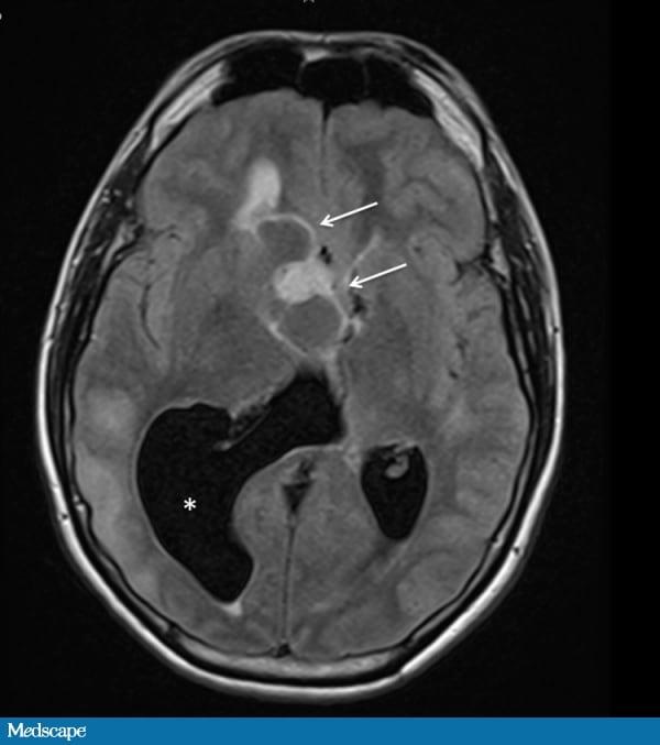 Tuberous Sclerosis Complex: Providing Guideline-based Care