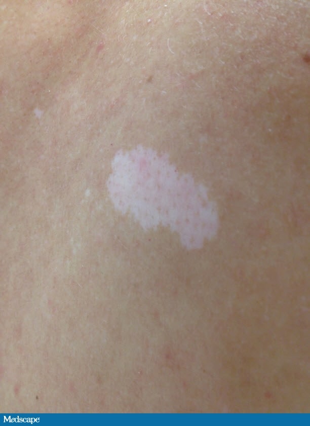 Tuberous Sclerosis Complex: Providing Guideline-based Care