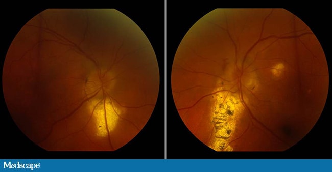 Gradual Loss of Vision and Chorioretinal Scarring