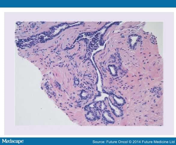 Prostate Changes Related to Therapy - Page 2