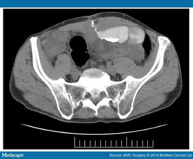 Blind loop: Rare but Important Surgical Complication - Page 3