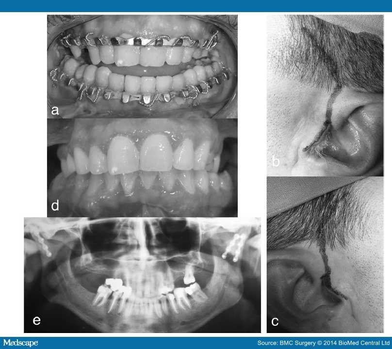 Treating Extracapsular Mandibular Condyle Fractures - Page 5