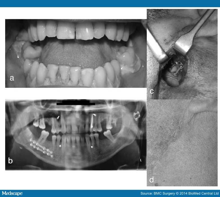Treating Extracapsular Mandibular Condyle Fractures - Page 5
