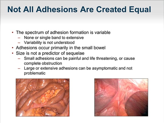 Preventing Abdominopelvic Adhesions: Practical Strategies and Best ...