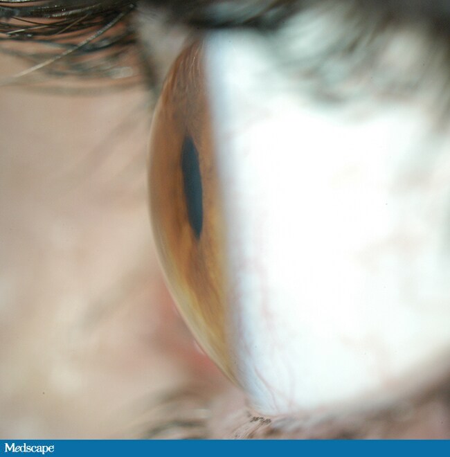 Corneal Abrasions: Managing a Commonly Occurring Injury - Page 2