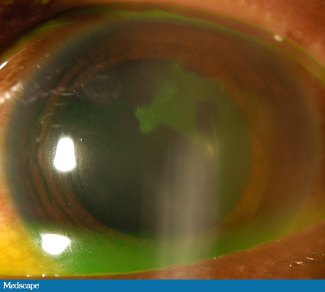 Corneal Abrasions: Managing a Commonly Occurring Injury - Page 3