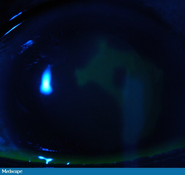 Corneal Abrasions: Managing a Commonly Occurring Injury - Page 3