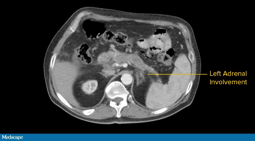 Fatigue, Weight Loss, Abdominal Cramping in 70-Year-Old Man - Page 3