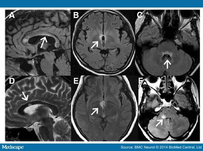 Cranial Magnetic Resonance Imaging Features of NMOSD vs. MS - Page 3