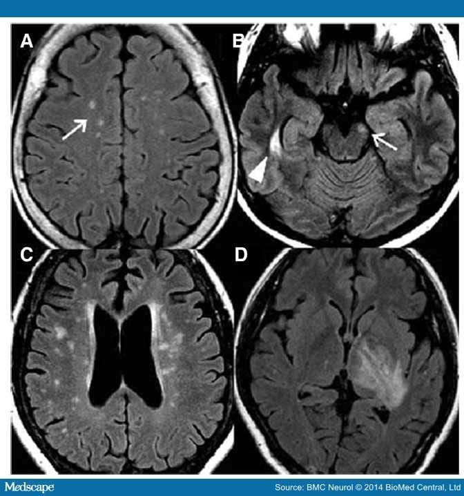 Cranial Magnetic Resonance Imaging Features of NMOSD vs. MS - Page 3