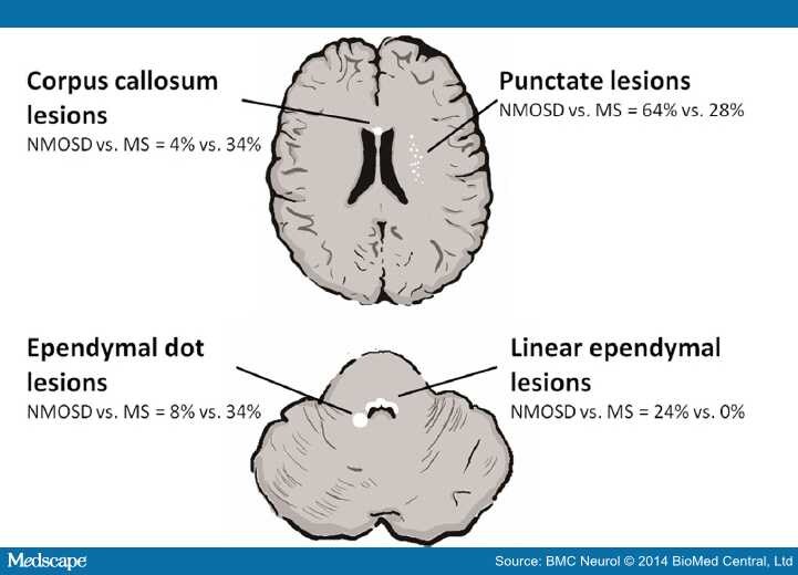 Cranial Magnetic Resonance Imaging Features of NMOSD vs. MS - Page 4