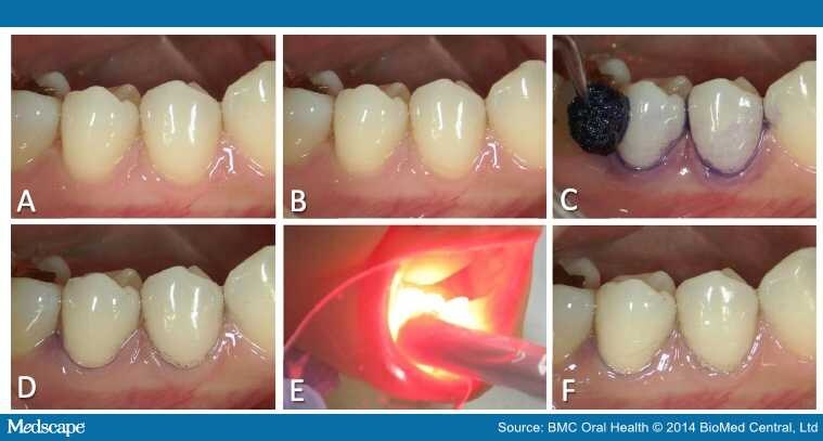 Antimicrobial Photodynamic Therapy Suppresses Dental Plaque