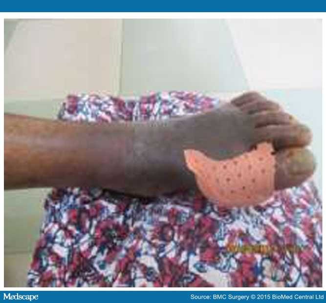 Treatment of the Diabetic Foot - Page 3