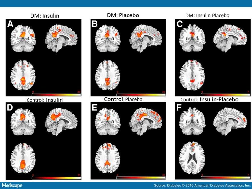 Intranasal Insulin Enhanced Functional Connectivity in T2D - Page 3 Intranasal Insulin Enhanced Functional Connectivity in T2D - Page 3