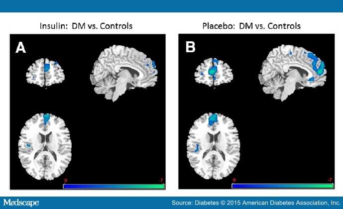 Intranasal Insulin Enhanced Functional Connectivity in T2D - Page 3 Intranasal Insulin Enhanced Functional Connectivity in T2D - Page 3