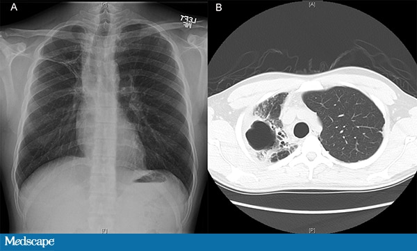 State of the Art: Treating Nontuberculous Mycobacterial Infections