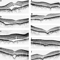 Focal Choroidal Excavation in Patients With Central Serous ...