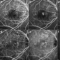 Focal Choroidal Excavation in Patients With Central Serous ...