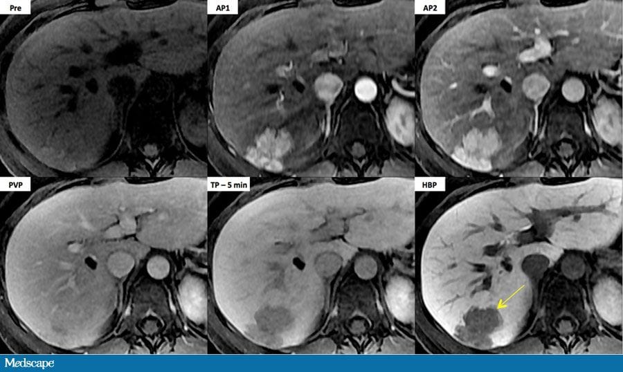 Understanding GBCAs to Optimize Outcomes