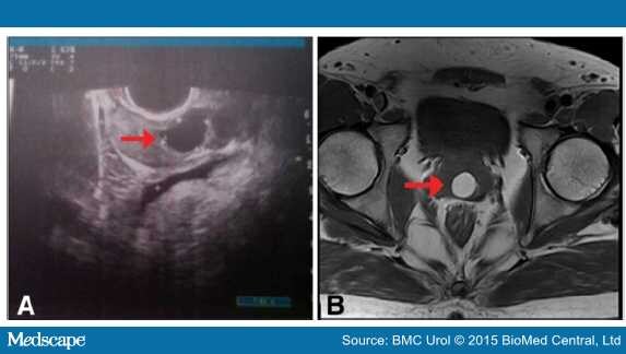 Surgery for Male Infertility Secondary to Prostatic Cyst - Page 3