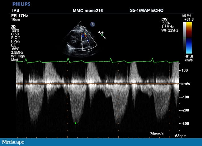 Allens Test Doppler