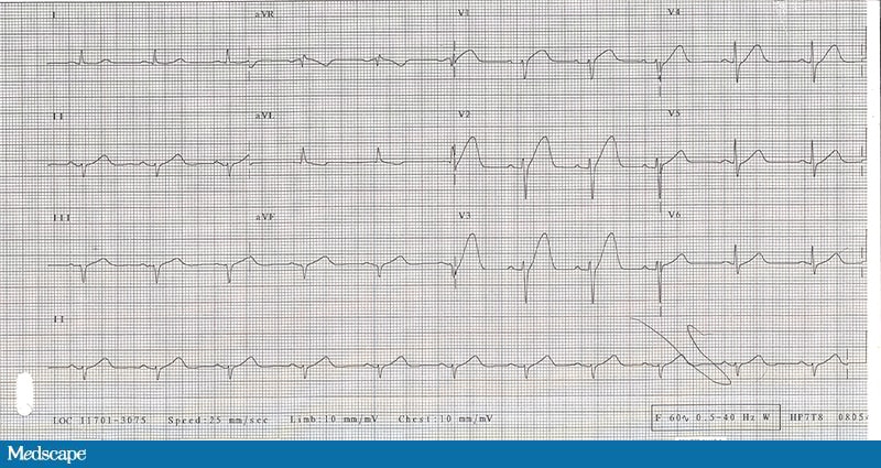 Where Is the Culprit Lesion?