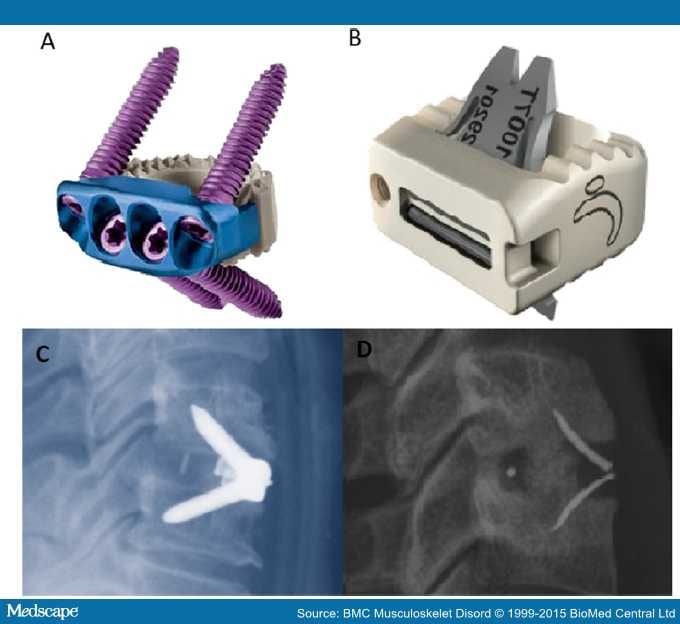 The Design Evolution of Interbody Cages in ACDF - Page 5