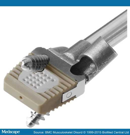 The Design Evolution of Interbody Cages in ACDF - Page 5