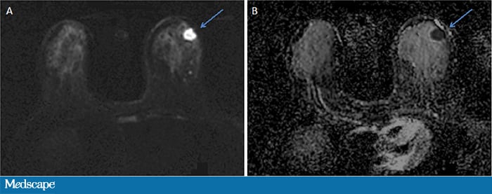 Optimizing MRI Breast Cancer Screening: A Multidisciplinary Perspective