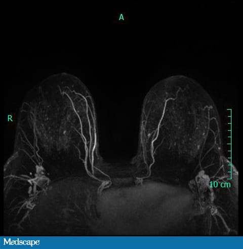 Optimizing MRI Breast Cancer Screening: A Multidisciplinary Perspective