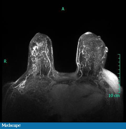 Optimizing MRI Breast Cancer Screening: A Multidisciplinary Perspective