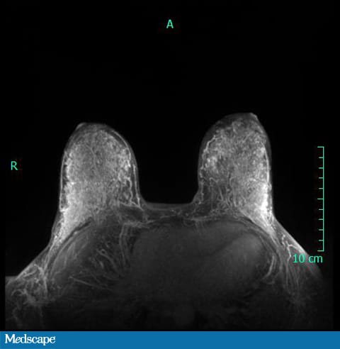 Optimizing MRI Breast Cancer Screening: A Multidisciplinary Perspective