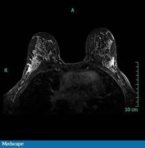 Optimizing MRI Breast Cancer Screening: A Multidisciplinary Perspective