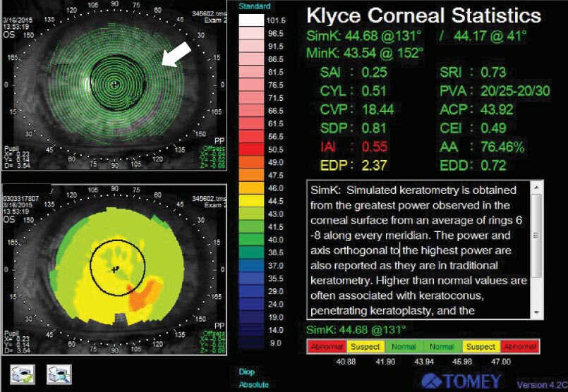 Case Challenges in Dry Eye Disease