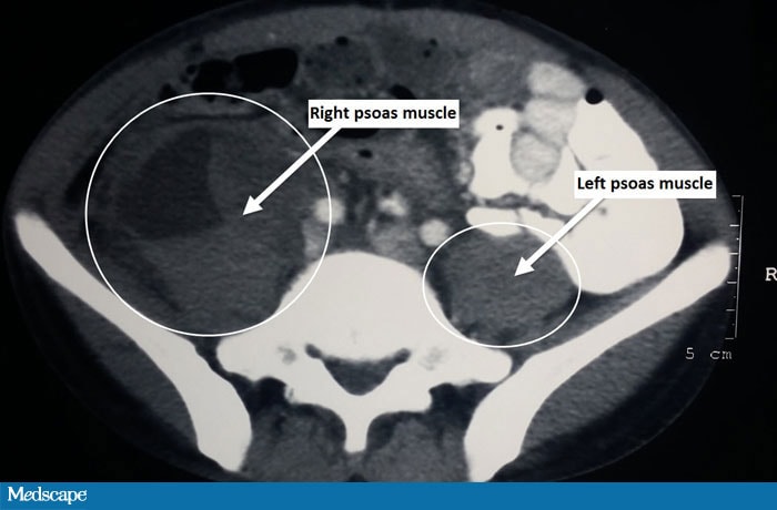 Challenges in the Management of Hemophilia in Adults