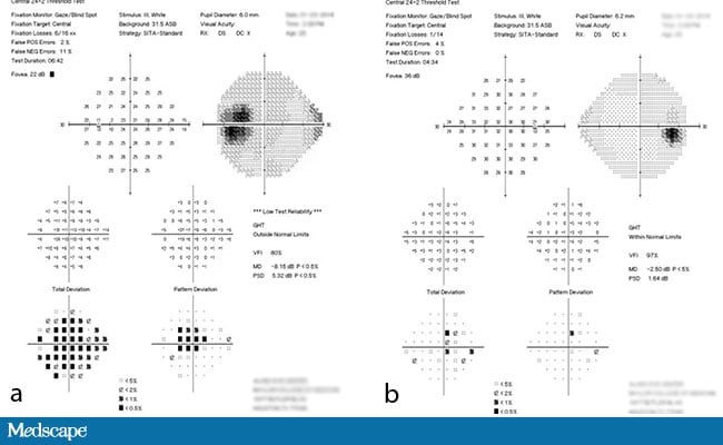 A Young Man With Visual Field Defects