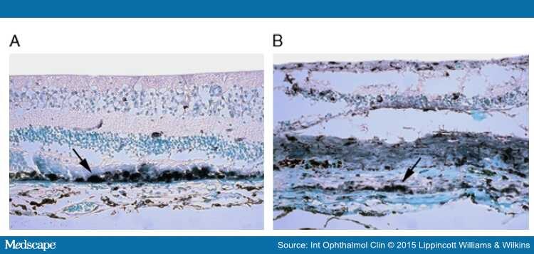 Inflammatory Mechanisms of Age-Related Macular Degeneration - Page 7