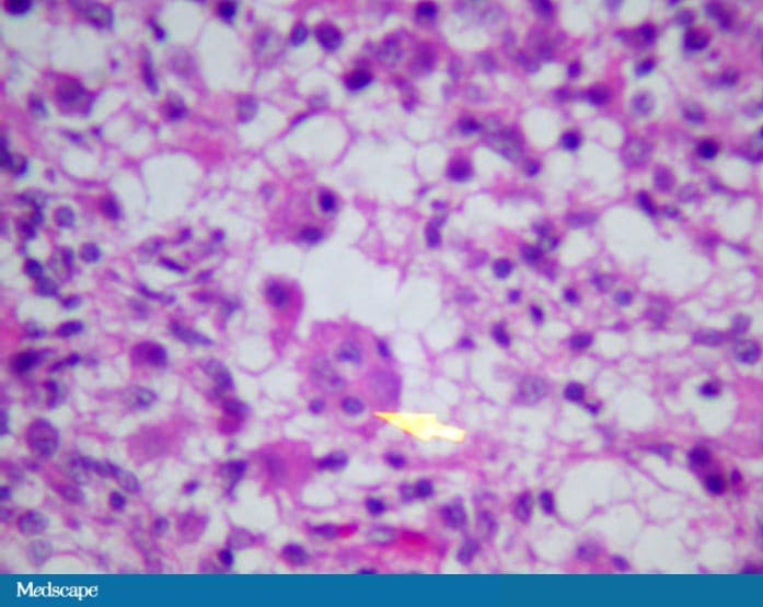 A 42-Year-Old Man With a Right Ear Mass - Page 2