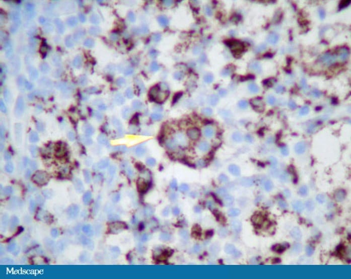 A 42-Year-Old Man With a Right Ear Mass - Page 2