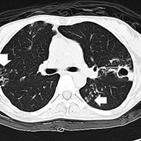 Mycobacterium abscessus Complex Infections in Humans