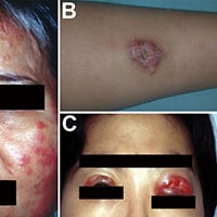 Mycobacterium abscessus Complex Infections in Humans