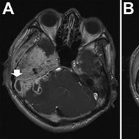 Mycobacterium abscessus Complex Infections in Humans
